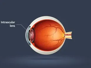 Cataracts & Lens Implants In Manhattan, NYC | Chelsea Eye Ophthalmology ...