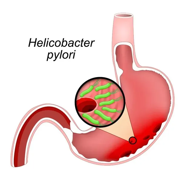 H Pylori Testing | Gastroenterologist in Forest Hills, NY | Forest ...