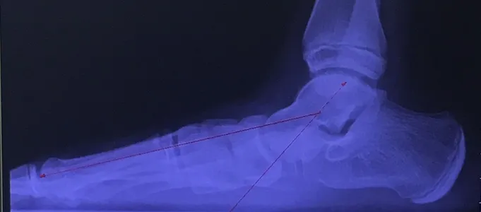 Flat Feet - Robert Sheinberg, DPM | Weston, FL Podiatrist