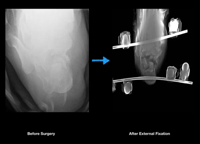 Calcaneus Fractures - Robert Sheinberg, DPM | Weston, FL Podiatrist