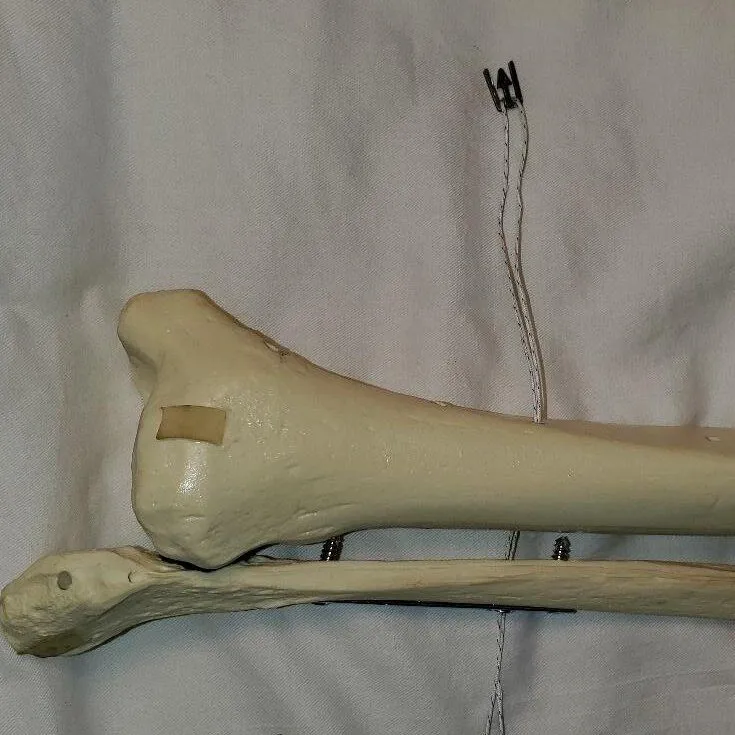 Suture Catch and Anchoring Technology | Podiatrist In Colorado Springs ...