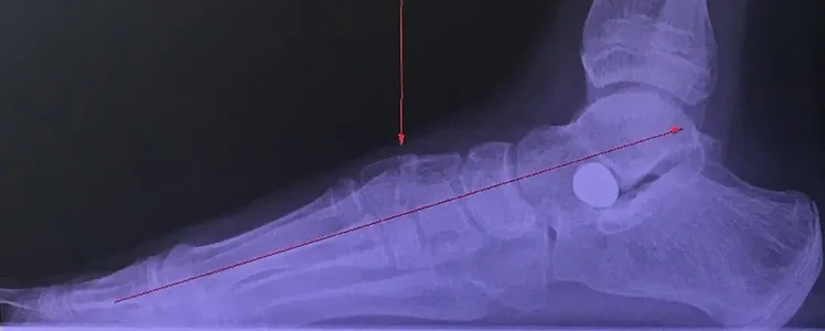 Flat Feet - Robert Sheinberg, DPM | Weston, FL Podiatrist