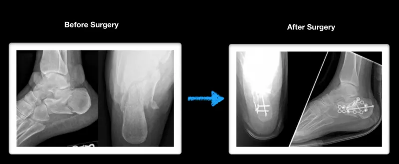 Calcaneal Fractures - Robert Sheinberg, DPM | Weston, FL Podiatrist