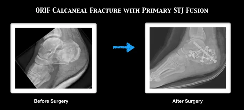 Calcaneal Fractures Robert Sheinberg Dpm Weston Fl Podiatrist