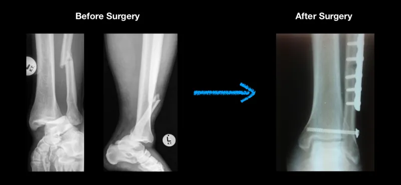 Fibula Fractures - Robert Sheinberg, DPM | Weston, FL Podiatrist