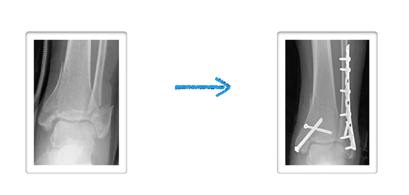 Bimalleolar Fractures - Robert Sheinberg, DPM | Weston, FL Podiatrist