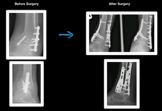Pilon Fractures - Robert Sheinberg, DPM | Weston, FL Podiatrist