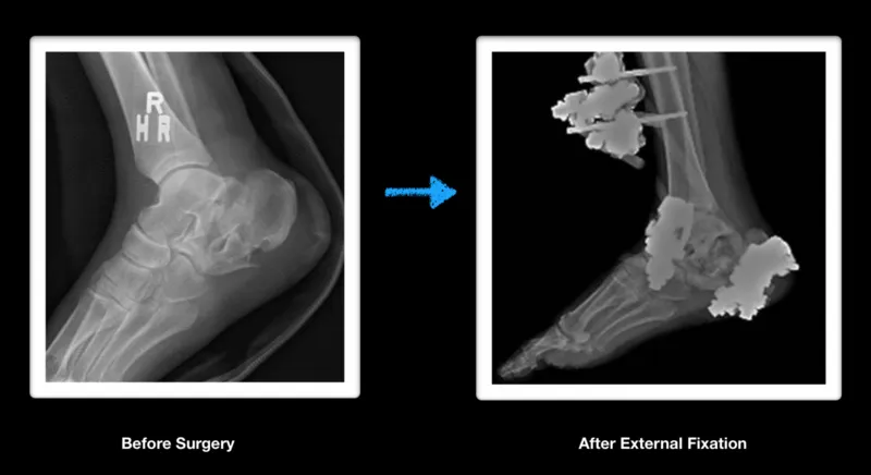 Calcaneal Fractures Robert Sheinberg Dpm Weston Fl Podiatrist