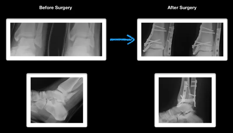 Trimalleolar Fractures - Robert Sheinberg, DPM | Weston, FL Podiatrist