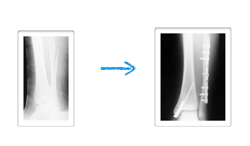 Bimalleolar Fractures - Robert Sheinberg, DPM | Weston, FL Podiatrist
