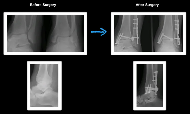 Trimalleolar Fractures - Robert Sheinberg, DPM | Weston, FL Podiatrist