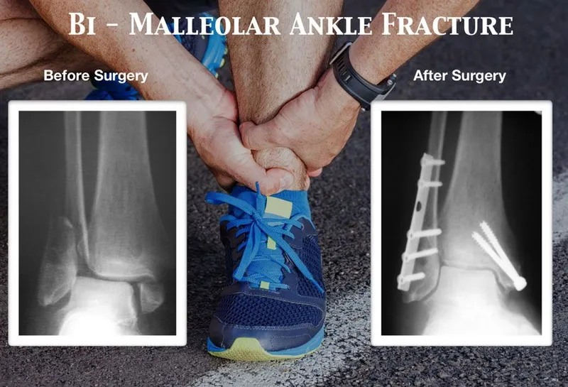 Bimalleolar Fractures - Robert Sheinberg, DPM | Weston, FL Podiatrist