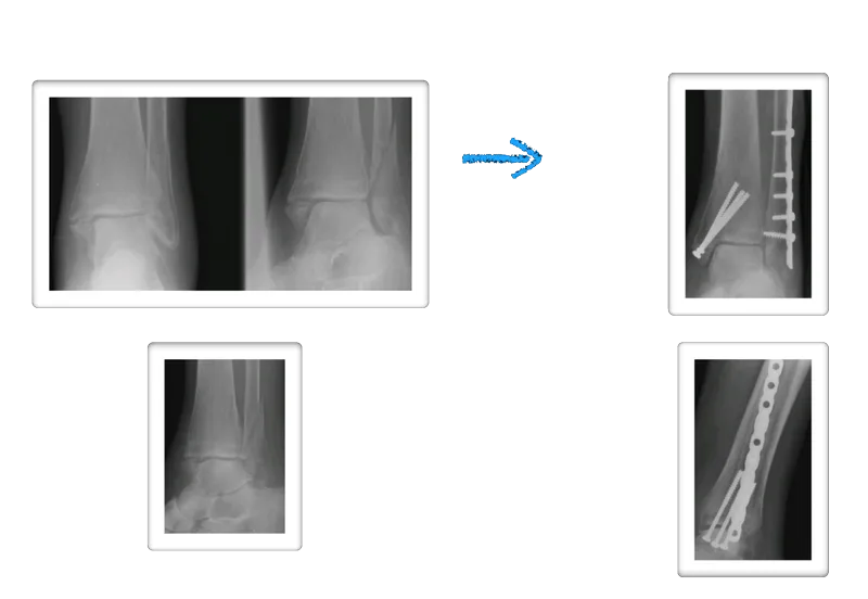 Bimalleolar Fractures - Robert Sheinberg, DPM | Weston, FL Podiatrist