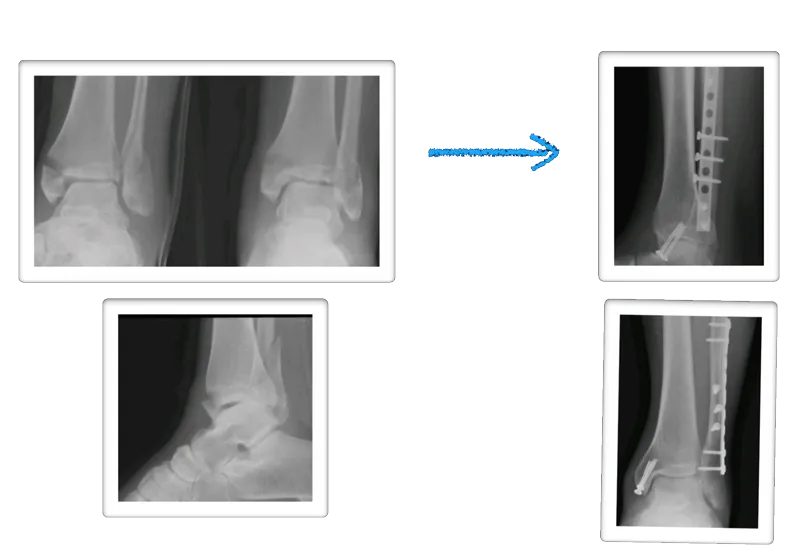 Bimalleolar Fractures - Robert Sheinberg, DPM | Weston, FL Podiatrist