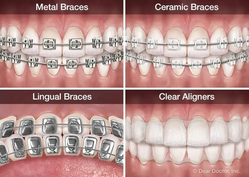 all braces types