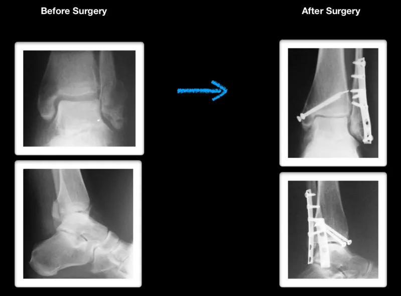 Posterior Malleolar - Robert Sheinberg, DPM | Weston, FL Podiatrist