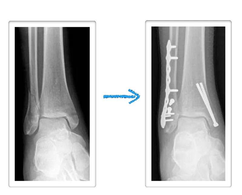Bimalleolar Fractures - Robert Sheinberg, DPM | Weston, FL Podiatrist