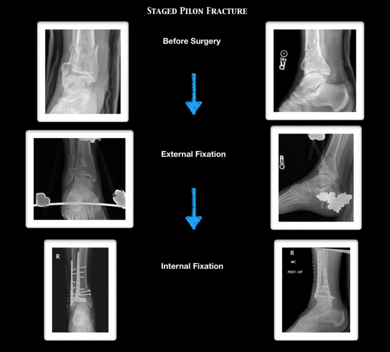 Pilon Fractures - Robert Sheinberg, DPM | Weston, FL Podiatrist