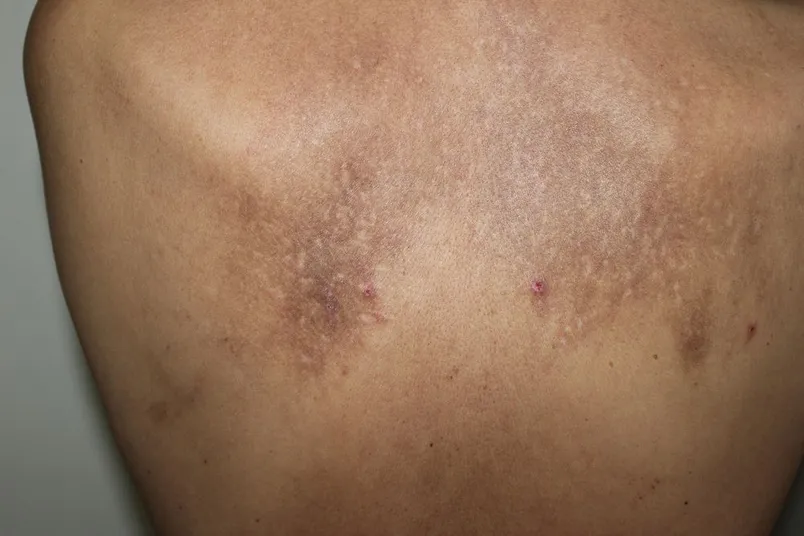 hyperpigmentation on back itchy