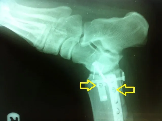 High Ankle Sprain - Robert Sheinberg, DPM | Weston, FL Podiatrist