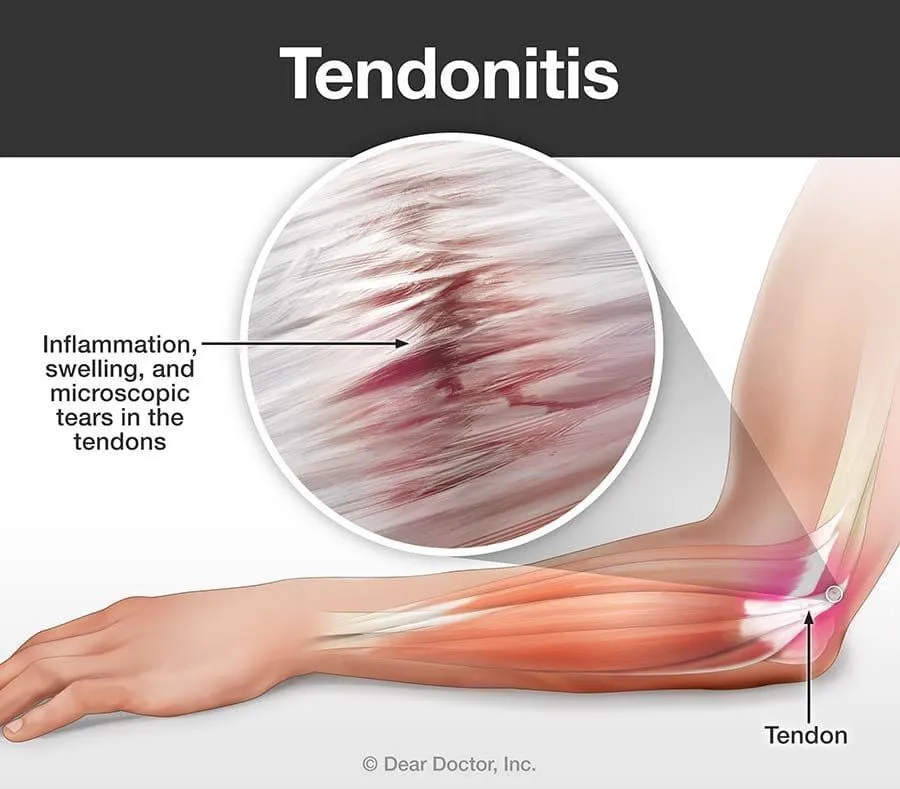 What is tendonitis? | What is inflammation of the tendons?