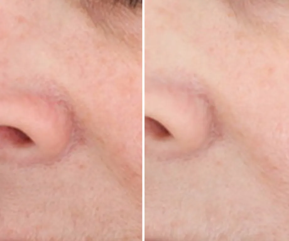 Chemical Peel - Tulsa Hills Cosmetic & Laser Skin Center | MedSpa Tulsa, OK