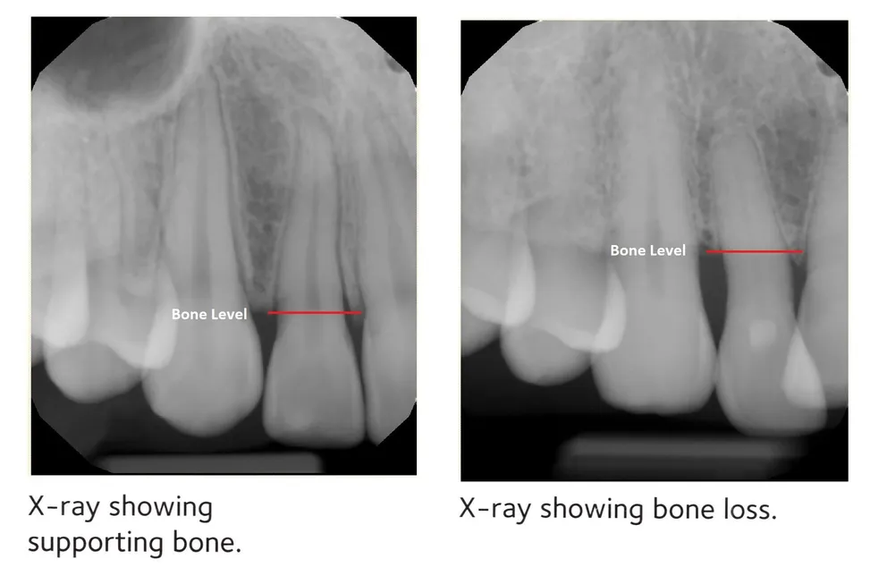 Dental Designs LC | Periodontal Disease in Kansas City